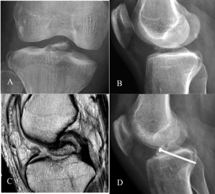 Cruciate ligament avulsion fractures: Anatomy, biomechanics, injury ...