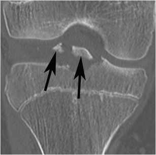 Cruciate ligament avulsion fractures: Anatomy, biomechanics, injury ...