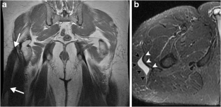 The Morel-Lavallée lesion: pathophysiology, clinical presentation ...