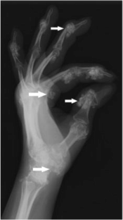 High-pressure paint gun injury: clinical presentation and imaging ...