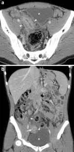 Inflammatory appendix mass in patients with acute appendicitis: CT ...