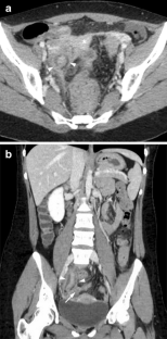 Inflammatory appendix mass in patients with acute appendicitis: CT ...