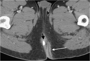 CT of acute perianal abscesses and infected fistulae: a pictorial essay ...