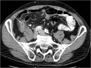Omental infarction and its mimics: imaging features of acute abdominal ...
