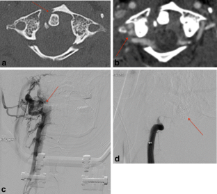 The spectrum of traumatic injuries at the craniocervical junction: a review of imaging findings ...