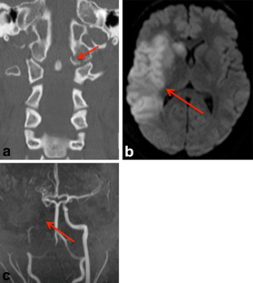 The spectrum of traumatic injuries at the craniocervical junction: a review of imaging findings ...
