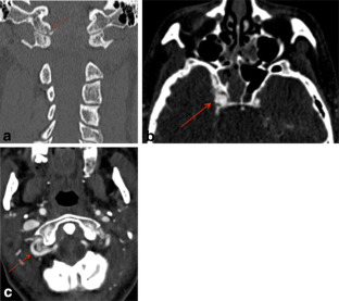 The spectrum of traumatic injuries at the craniocervical junction: a review of imaging findings ...