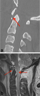 The spectrum of traumatic injuries at the craniocervical junction: a review of imaging findings ...