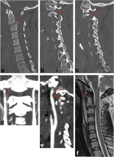 The spectrum of traumatic injuries at the craniocervical junction: a review of imaging findings ...