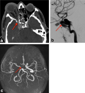 The spectrum of traumatic injuries at the craniocervical junction: a review of imaging findings ...