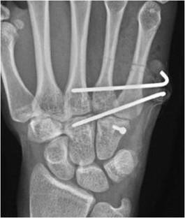 Subtle radiographic signs of hamate body fracture: a diagnosis not to ...
