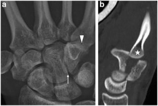 Subtle radiographic signs of hamate body fracture: a diagnosis not to ...