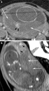 Placental abruption and hemorrhage—review of imaging appearance ...