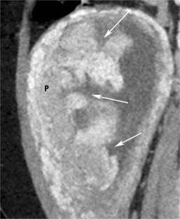 Placental abruption and hemorrhage—review of imaging appearance ...