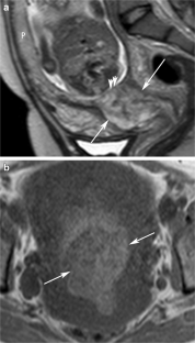 Placental abruption and hemorrhage—review of imaging appearance ...