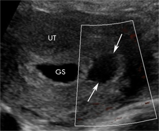 Placental abruption and hemorrhage—review of imaging appearance ...