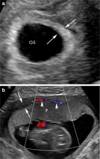 Placental abruption and hemorrhage—review of imaging appearance ...