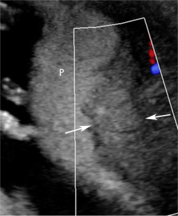 Placental abruption and hemorrhage—review of imaging appearance ...