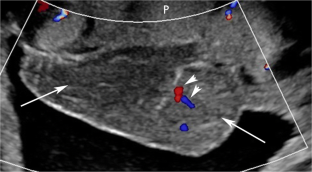 Placental abruption and hemorrhage—review of imaging appearance ...