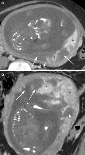 Placental abruption and hemorrhage—review of imaging appearance ...
