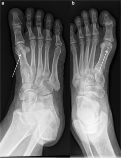 Accessory ossicles of the foot—an imaging conundrum | SpringerLink