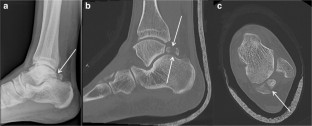 Accessory ossicles of the foot—an imaging conundrum | SpringerLink