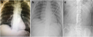 The resuscitative endovascular balloon occlusion of aorta (REBOA ...
