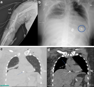 Radically Invasive Projectiles—first reports and imaging features of ...