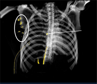 Radically Invasive Projectiles—first reports and imaging features of ...