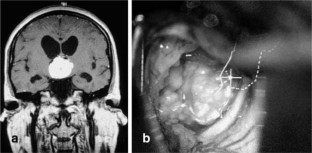 Transcortical or transcallosal approach to ventricle-associated lesions ...
