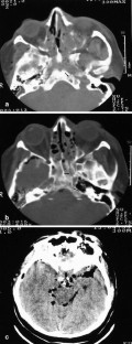 Clivus fractures: clinical presentations and courses | SpringerLink