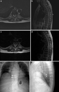 Surgical treatment of thoracic disc disease via minimally invasive ...