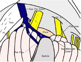 Anatomy of the superior petrosal veins and their exposure and ...
