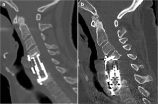 Two-level cervical corpectomy—long-term follow-up reveals the high rate ...