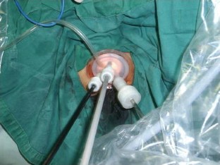 Transanal single-port laparoscopic total mesorectal excision in the ...