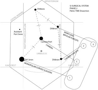 Robotic low anterior resection: how to maximise success in difficult ...