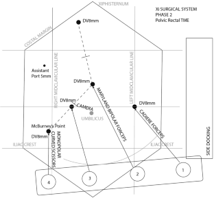 Robotic low anterior resection: how to maximise success in difficult ...