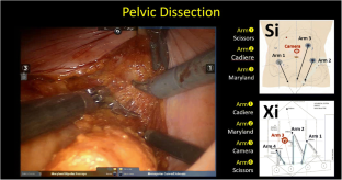 Robotic low anterior resection: how to maximise success in difficult ...