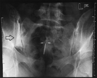 Osteitis condensans ilii in differential diagnosis of patients with ...