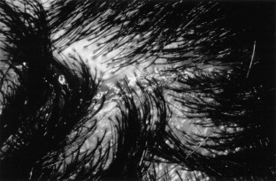 Pyodermatitis–Pyostomatitis Vegetans: Two Cases and a Review of the ...