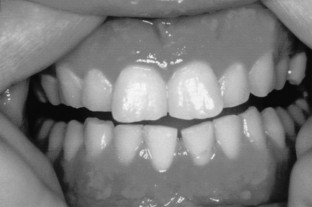 Pyodermatitis–Pyostomatitis Vegetans: Two Cases and a Review of the ...