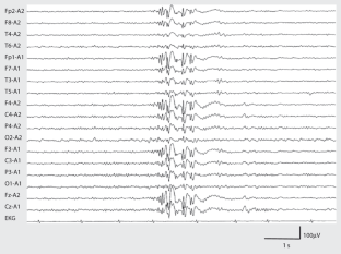 Systematischer Zugang zur EEG-Befundung bei Epilepsie | SpringerLink