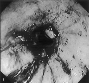 The Strictured Anastomosis: Successful Treatment by Corticosteroid ...