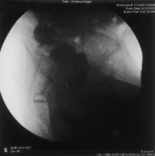 The Strictured Anastomosis: Successful Treatment by Corticosteroid ...