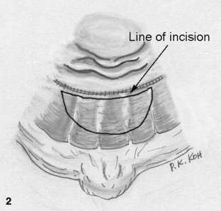 Mucosal Flap Excision for Treatment of Remnant Prolapsed Hemorrhoids or ...