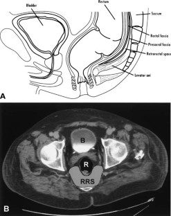 Tumors of the Retrorectal Space | SpringerLink