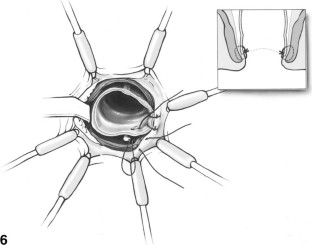 Technique and Long-Term Results of Intersphincteric Resection for Low ...