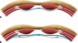 Laparoendoscopic stapled rives stoppa sublay technique for ...