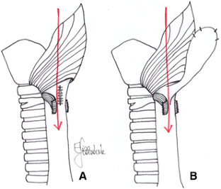 Surgical treatment for Zenker’s diverticulum: comparison between ...