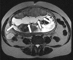 Placental multiple chorionic cysts in maternal scleroderma | SpringerLink
